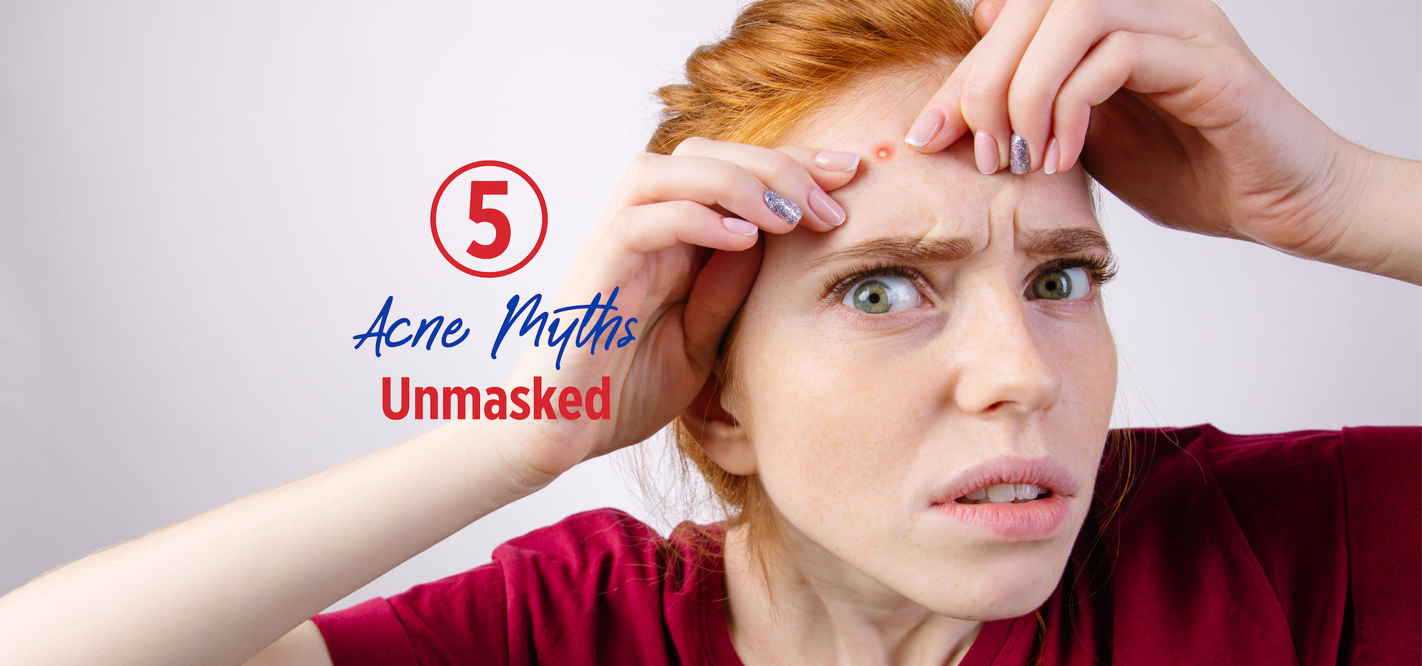 5 Acne Myths Unmasked – Zinplex South Africa